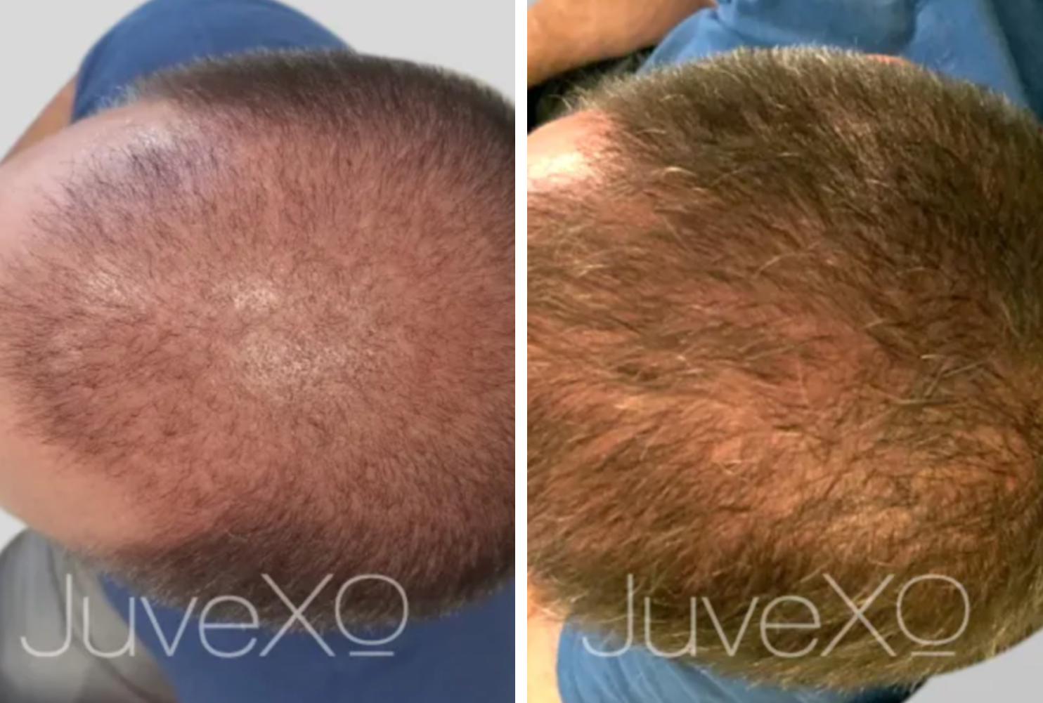 JuveXO | Superior Exosomes
