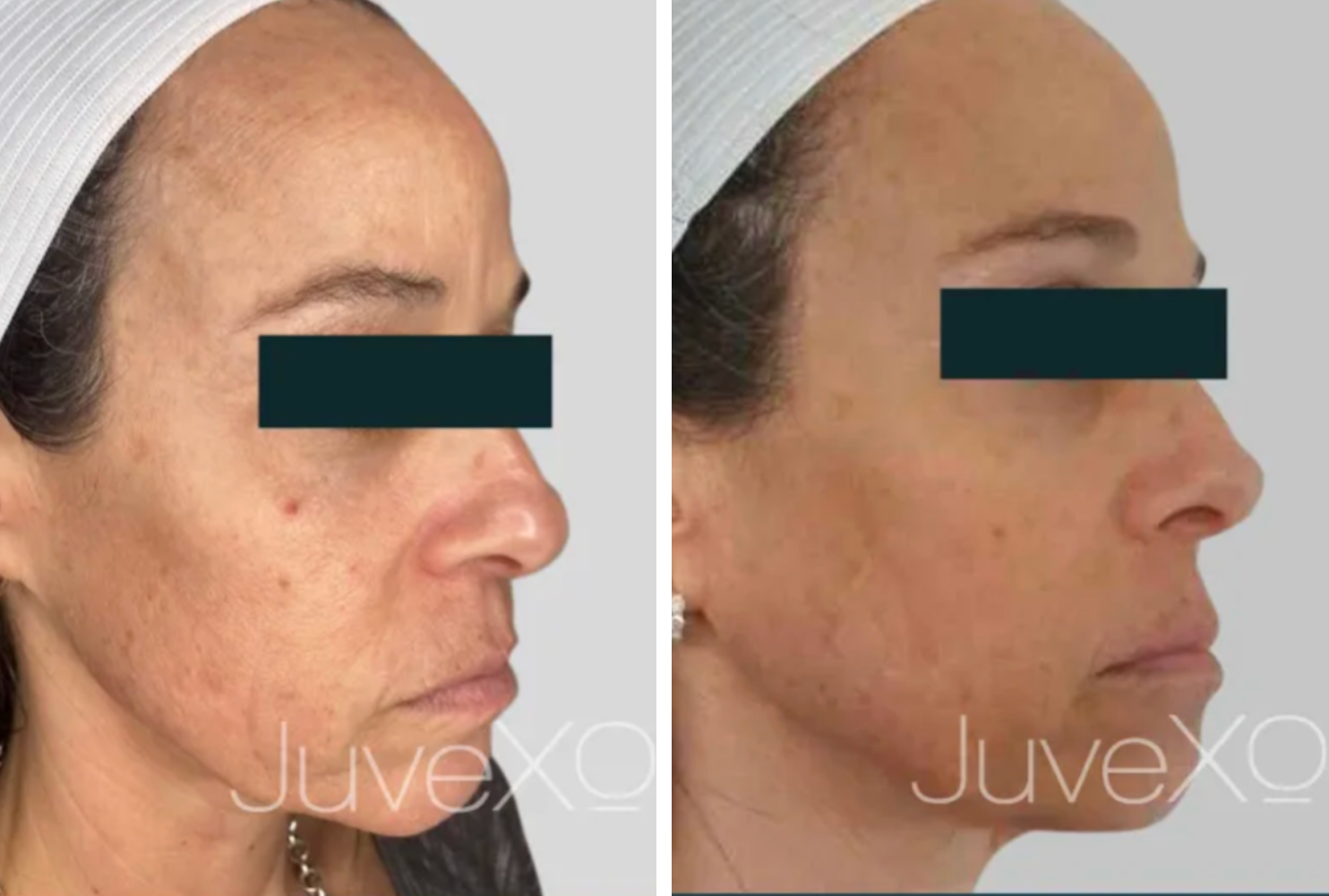 XO Lift™ – JuveXO
